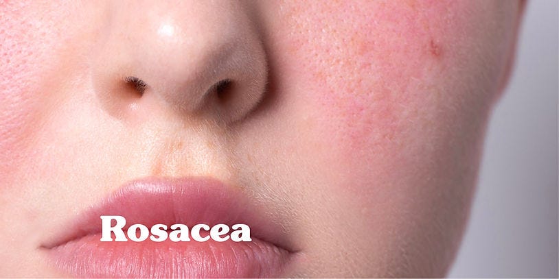 Photosensitive foods and drugs. Photosensitivity is the term used to ...