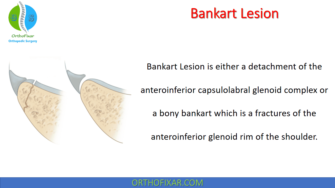 Bankart Lesion