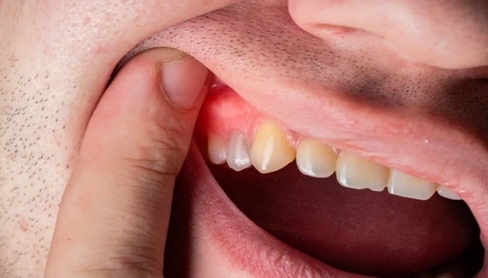 Signs Your Baby’s Teeth Are Coming In and What to Expect — Grove Dental ...
