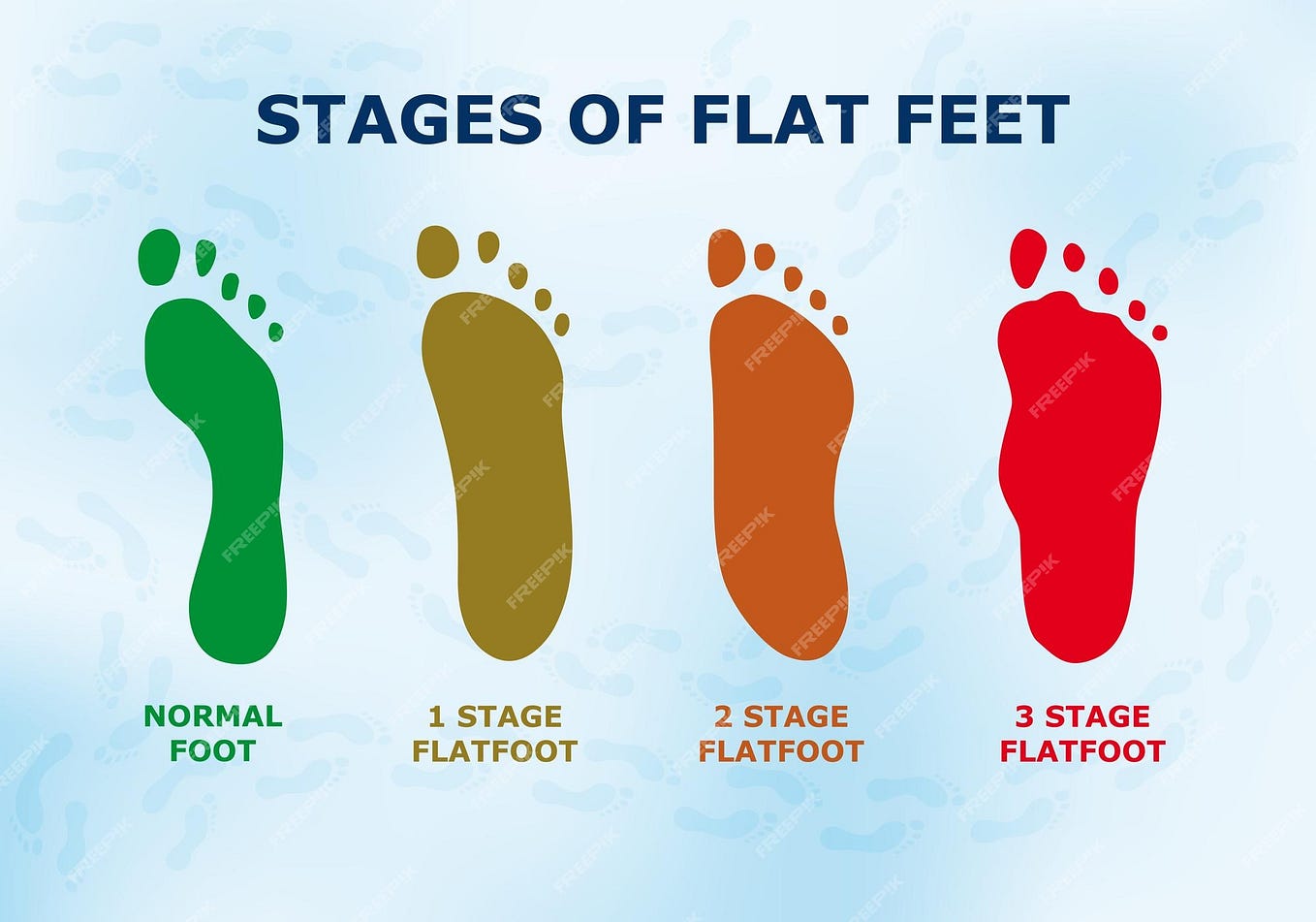 The Ultimate Guide to High Arch Support: Find the Perfect Solutions for ...