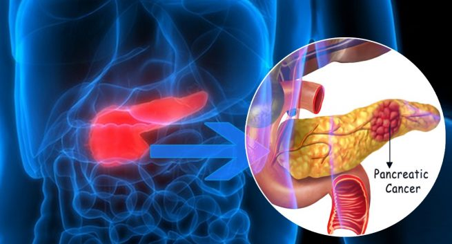 OncoSil Medical Marks Milestone with Successful Pancreatic Cancer ...