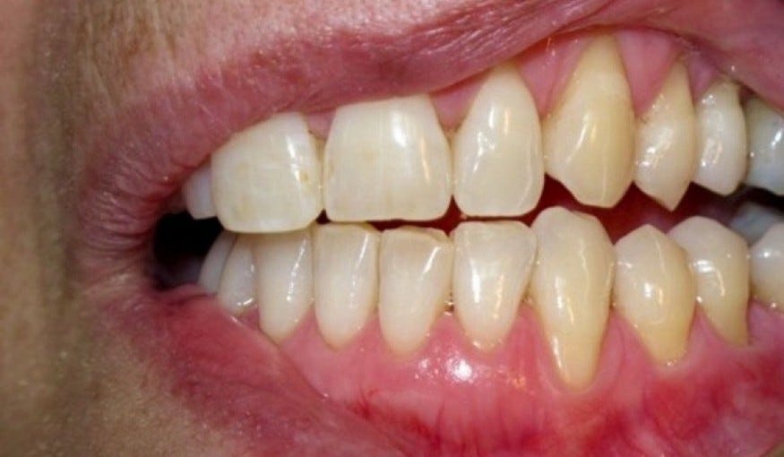 60 Second Trick To Rebuild Your Teeth with Simple Trick | by Naturally ...