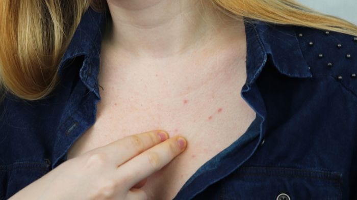 How to Get Rid of Chest Acne Overnight? | by Medicalcave | Medium