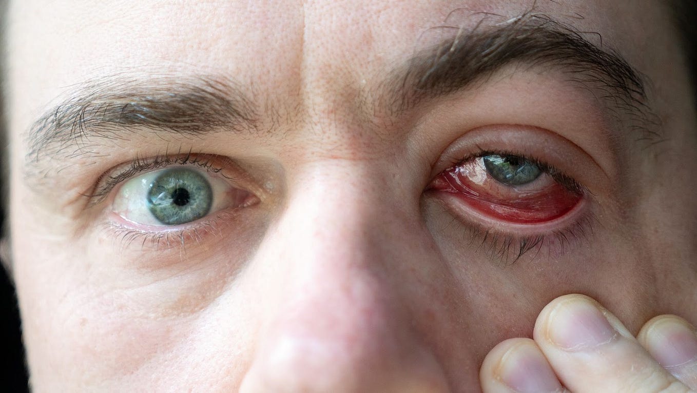 Beat the Heat: Safeguarding Your Eyes During Summer | by Dr. Surbhi ...