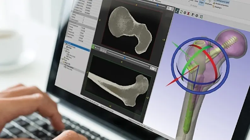 What is CAD Design Automation Role in Making Custom Implants? | by ...