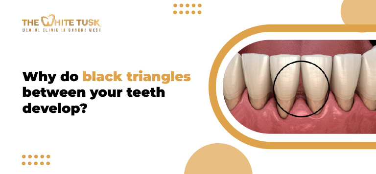 Difference Between Dental Crowns And Veneers | by White Tusk Care | May ...