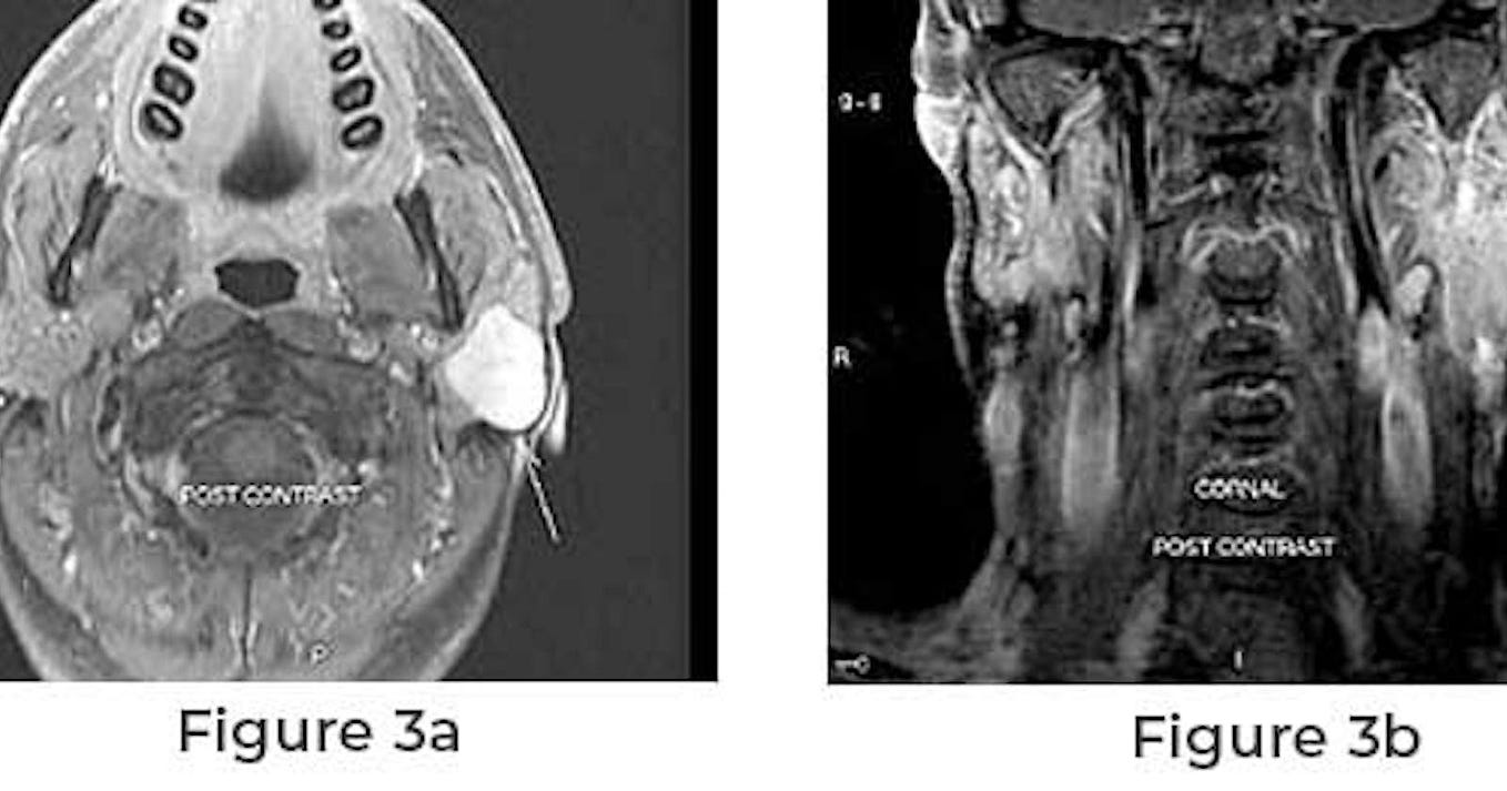 Parotidectomy and Facelift: Understanding the Interplay between Two ...