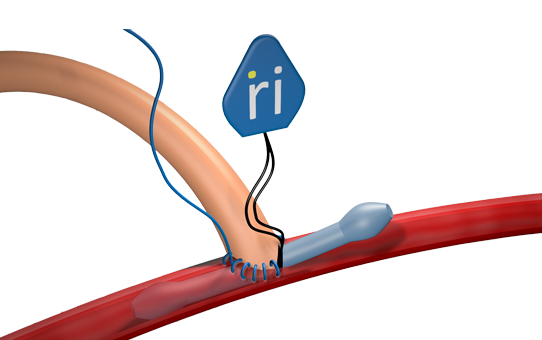 BioMime | Drug Eluting Stents for heart attack after Chest Pain | Meril ...