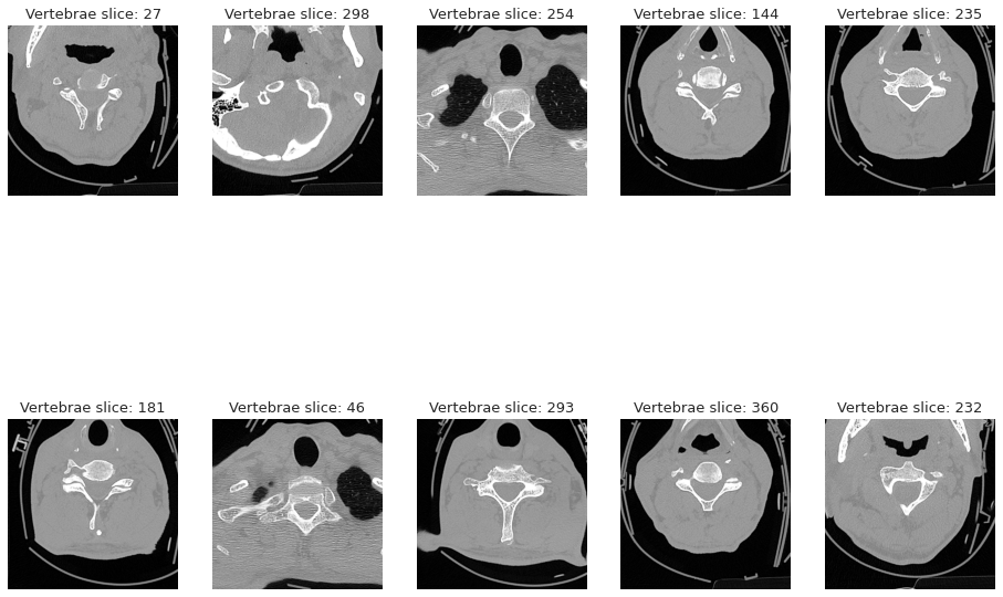 Improving Cervical Spine Fracture Detection Via Machine Learning By Eishafnu Medium