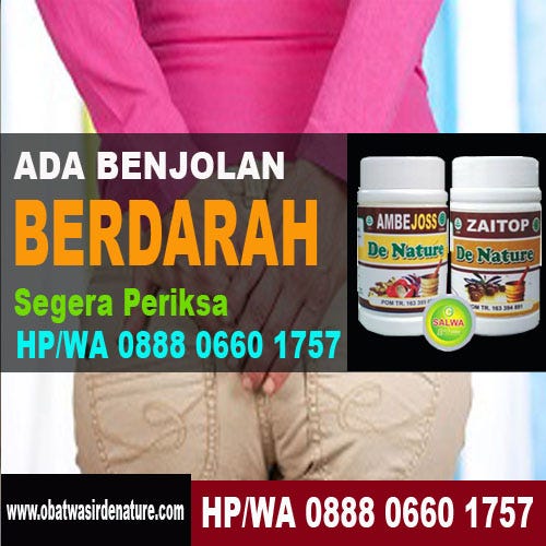 Obat Tradisional Wasir Stadium 4. OBAT TRADISIONAL WASIR STADIUM 4 ...