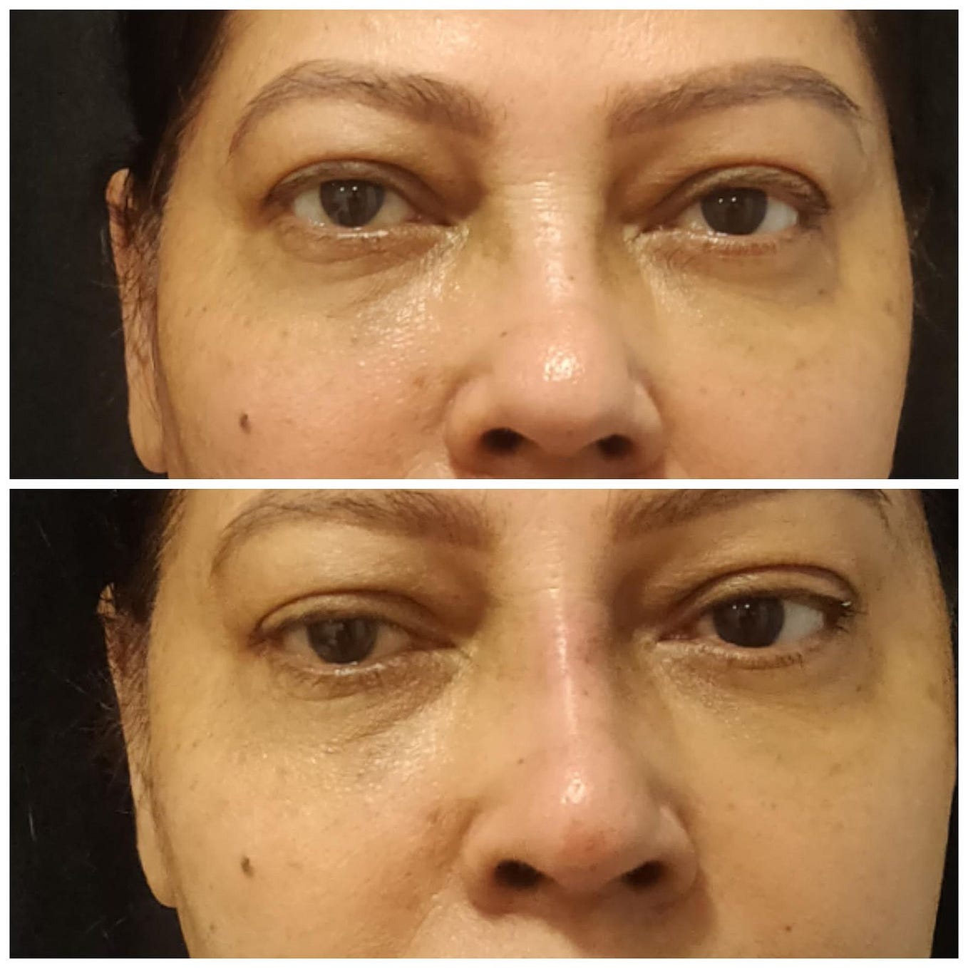 Nose Correction Without Surgery: Exploring Non-Surgical Rhinoplasty ...