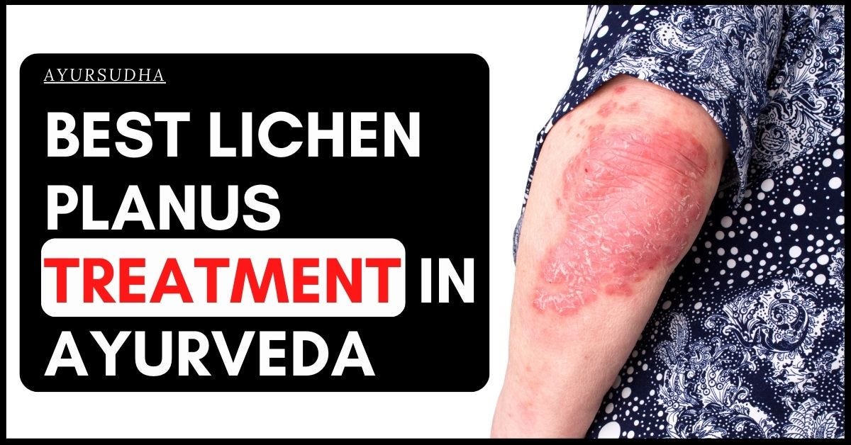 HERE ARE THE 5+ BEST LICHEN PLANUS TREATMENT IN AYURVEDA - Ayursudha ...