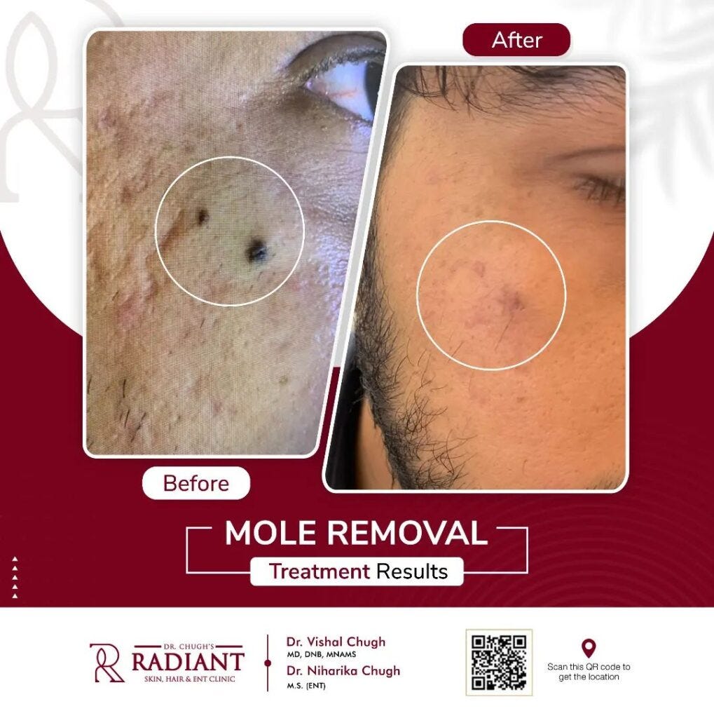 Achieving Clear Skin: Acne Scar Treatment in Jaipur | by Radiant Skin ...