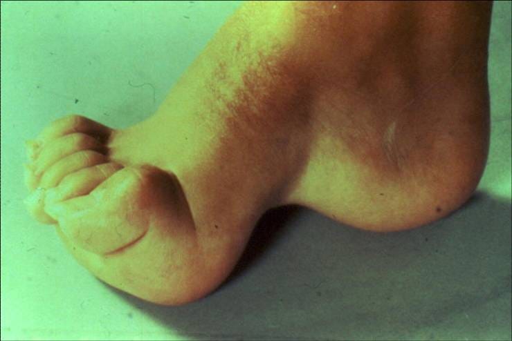 Maple Syrup Urine Disease: Sweet Name, Serious Condition | by Hayden ...