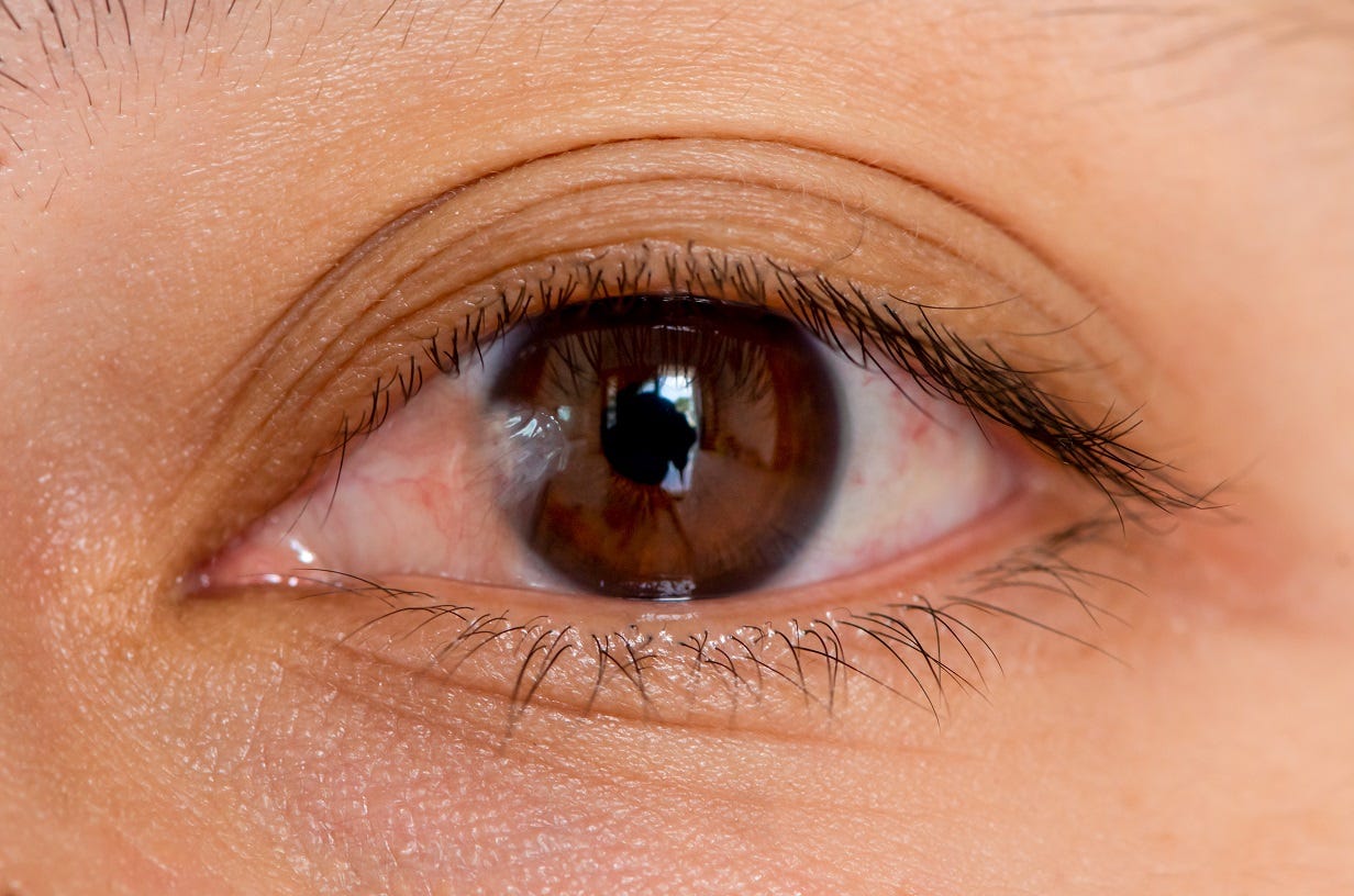 carnosidad tratamiento - Hustonlasikeye - Medium