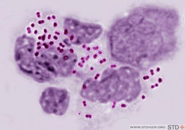 Top 5 Most Dangerous STDs. Contracting a sexually transmitted… | by ...