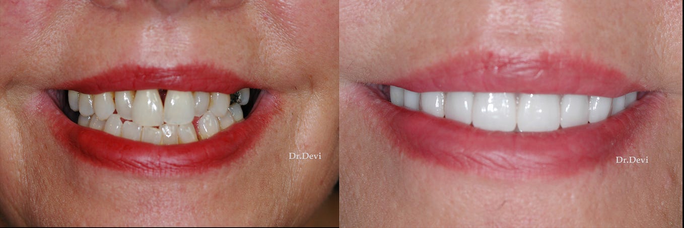 New Teeth, New Smile: The Transformation That Changes Lives | by Dr ...