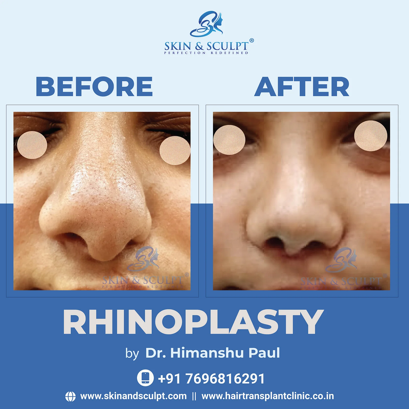 Rhinoplasty Surgery: What to Expect Before, During and After | by Skin ...