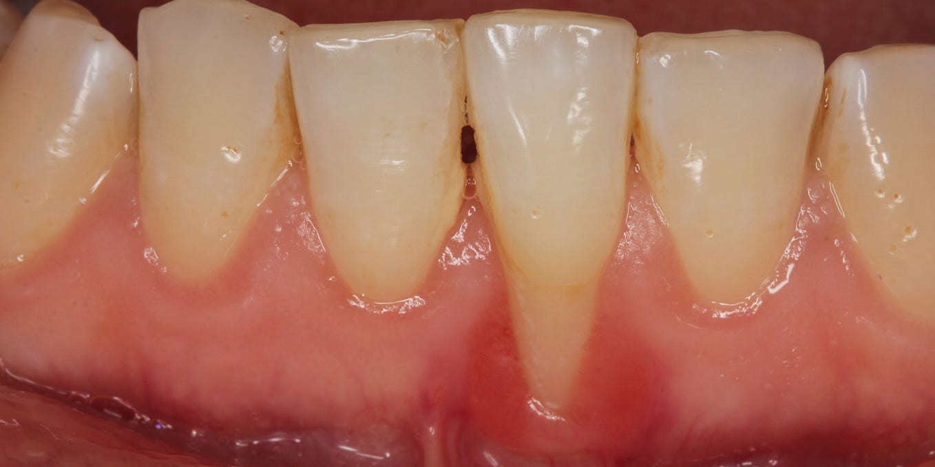 #1 Sure Sign That Your Teeth Are Being Destroyed By The ‘Silent Reflux ...