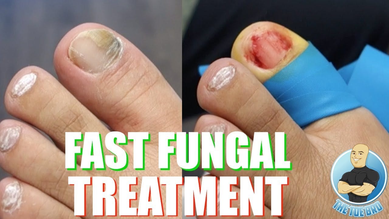 Sacred African trick destroys toenail fungus in no time Completely | by ...