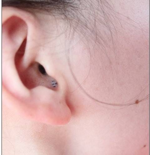 How to get rid of blackheads in your ear | by Sally Edward | Medium
