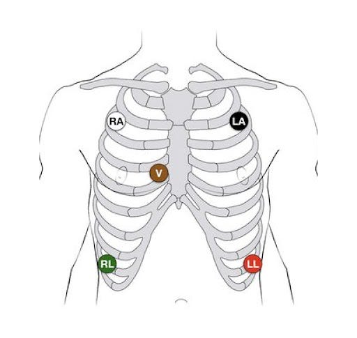 Understanding Epsilon Wave ECG: A Crucial Indicator in Cardiology | by ...