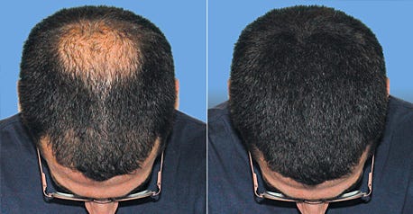 Hair transplant in Patna - Get cost and Clinic details. | by Ruchi Sah ...