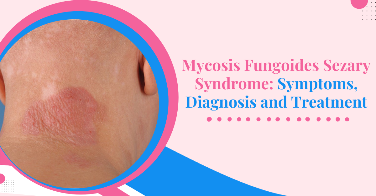 WHAT IS NASOPHARYNGEAL CANCER: CAUSES, SYMPTOMS, & TREATMENT? - Dr ...