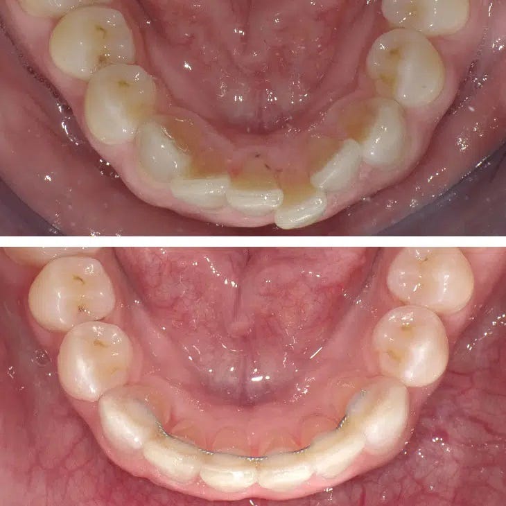 Why It’s Important to Wear a Retainer? | by Gibbs Orthodontic ...