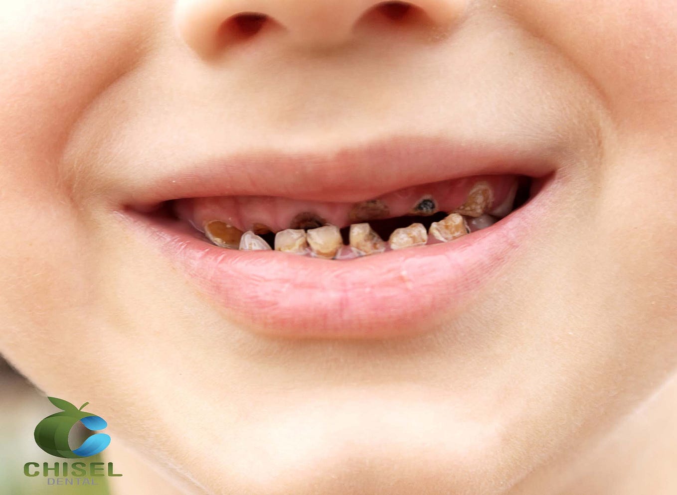 For Sensitive Teeth, what can you do? | by Chisel Dental Clinic ...