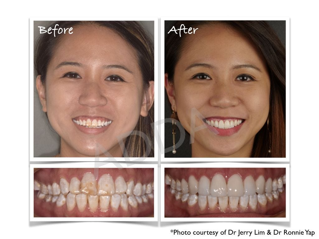 Smile Makeover Case Study 13: Porcelain Veneers and Invisalign Before ...