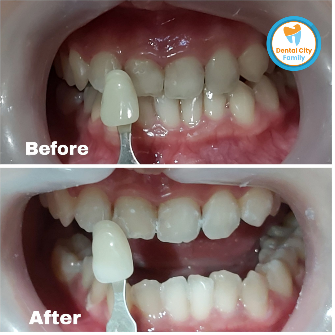 Perawatan Behel Gigi Terbaik Jakarta, Depok, dan Bekasi | by Dental ...