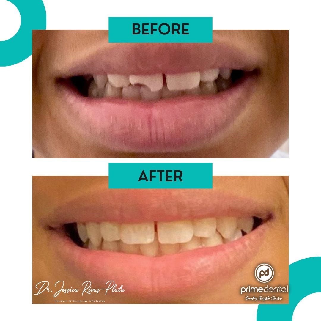 Rejuvenate Your Smile: The Ultimate Guide to Smile Line Fillers | by ...