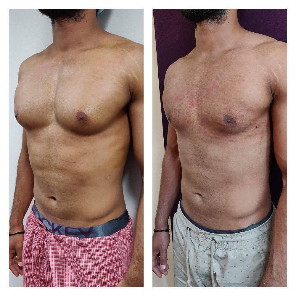 What is breast surgery for? - Nishu Tiwari - Medium
