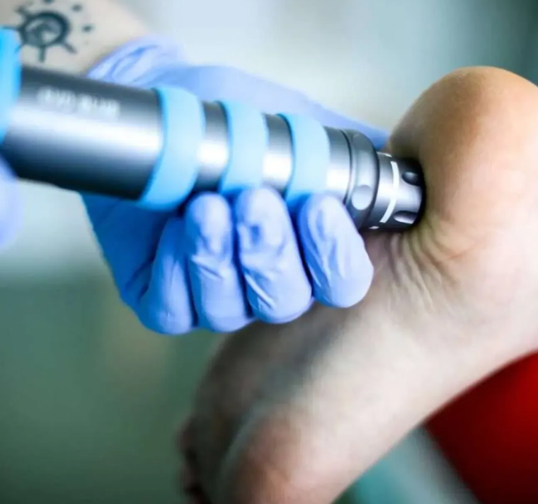 Experience Relief with Curacorn Filler Therapy: Banishing Corns for ...