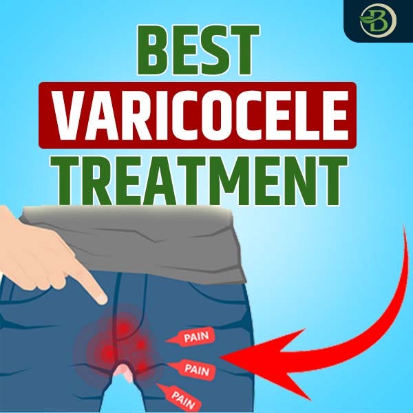 Natural Treatment Of Varicocele Without Surgery By Bharat Homeopathy
