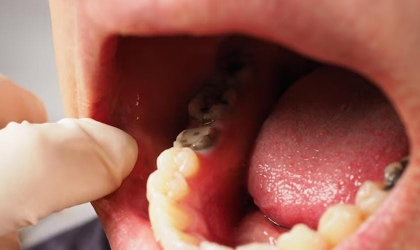 Signs of HPV in the Mouth. Discover signs of oral HPV at Belmont… | by Belmont Dentistry | Medium