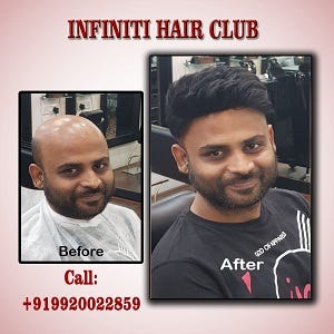 Why Choose Non-Surgical Hair Replacement services | by Infiniti Hair ...
