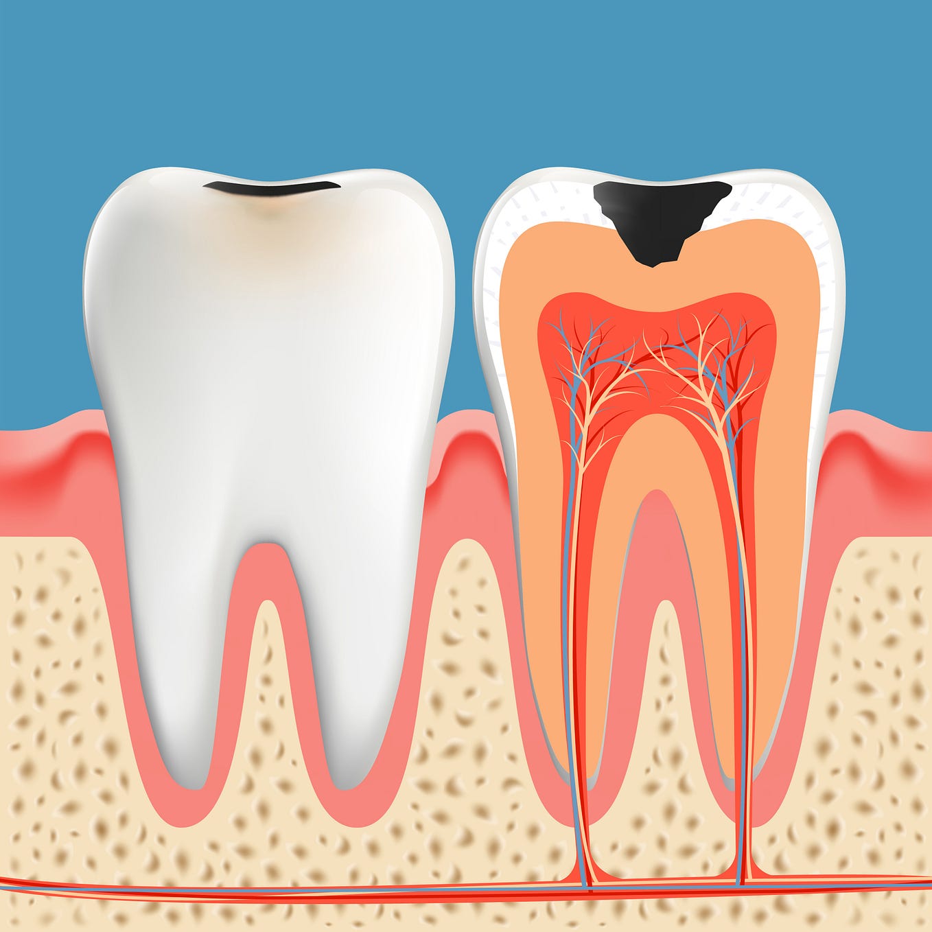 How Does One Stop And Reverse The Process Of Tooth Decay? [Reverse It ...