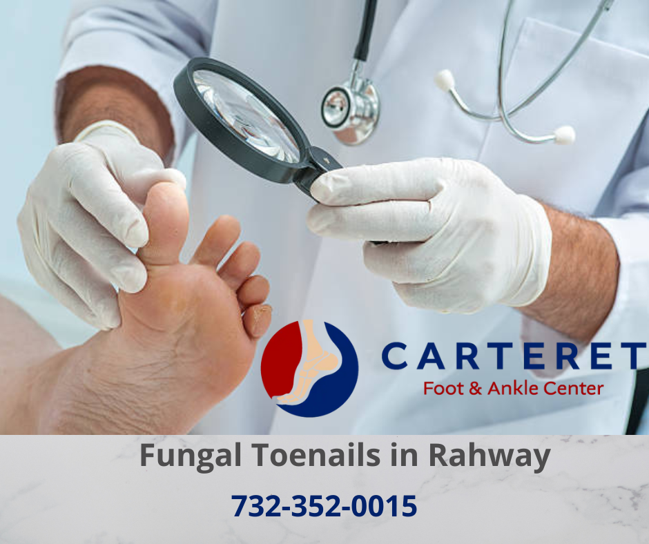 Flat Foot in Elizabeth - carteretfoot doctor - Medium