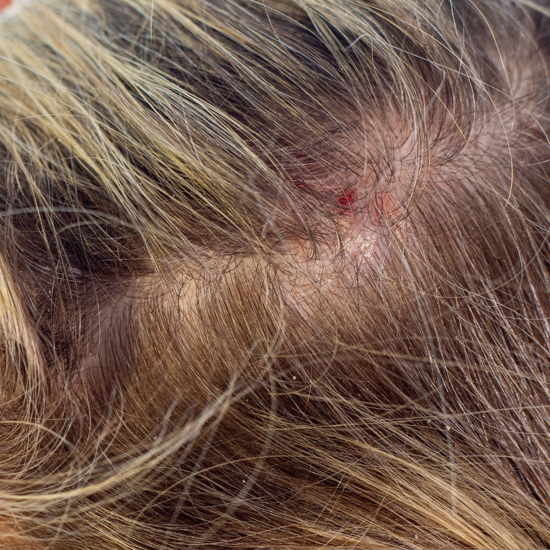 5 Ways to Prevent Scalp Pimples. Ouch! What’s That on My Scalp? | by ...
