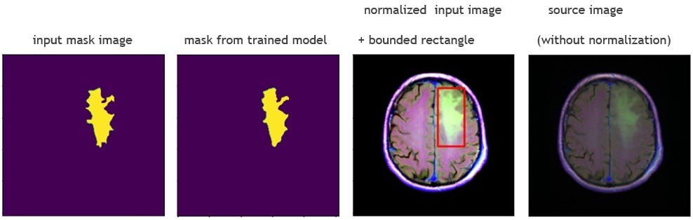 Vision Transformer for semantic segmentation on medical images. Practical uses and experiments ...