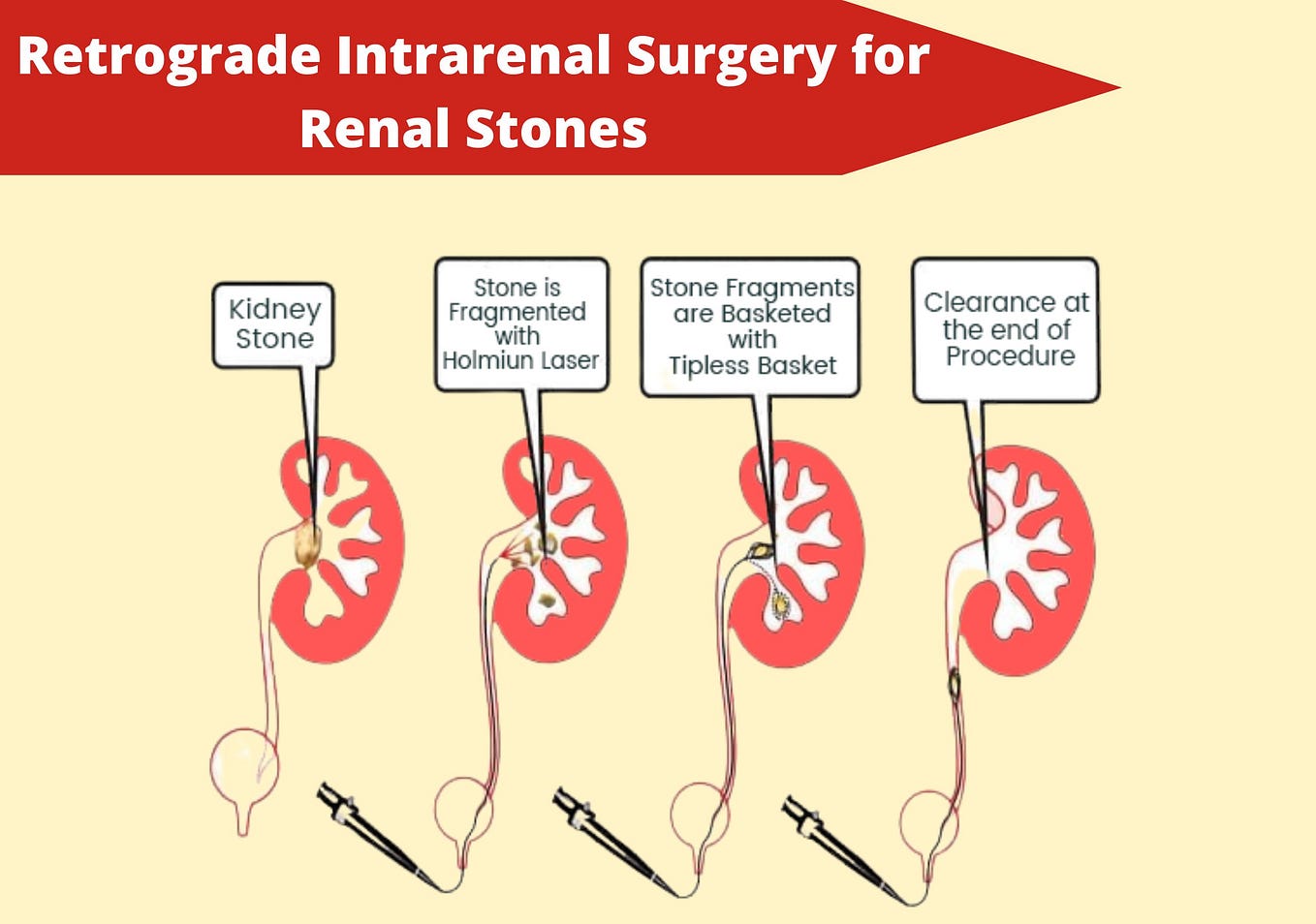 How is RIRS Surgery Performed?. Retrograde Intrarenal Surgery (RIRS) is ...