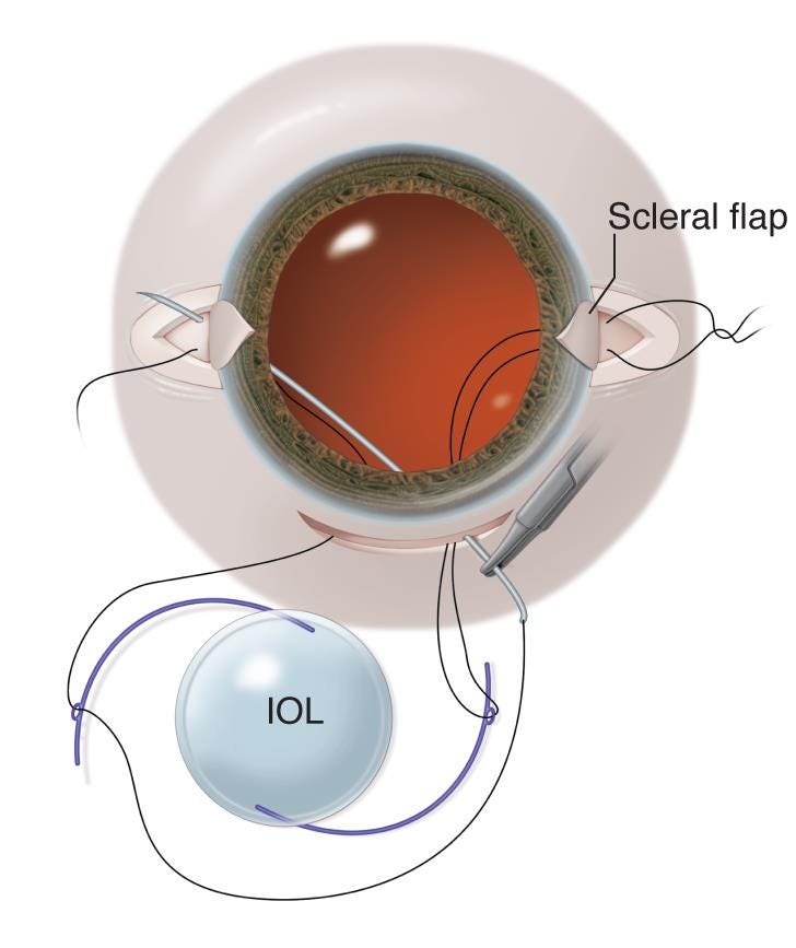 What are the symptoms of vitreous hemorrhage? | by Dr. Vaidya Eye ...