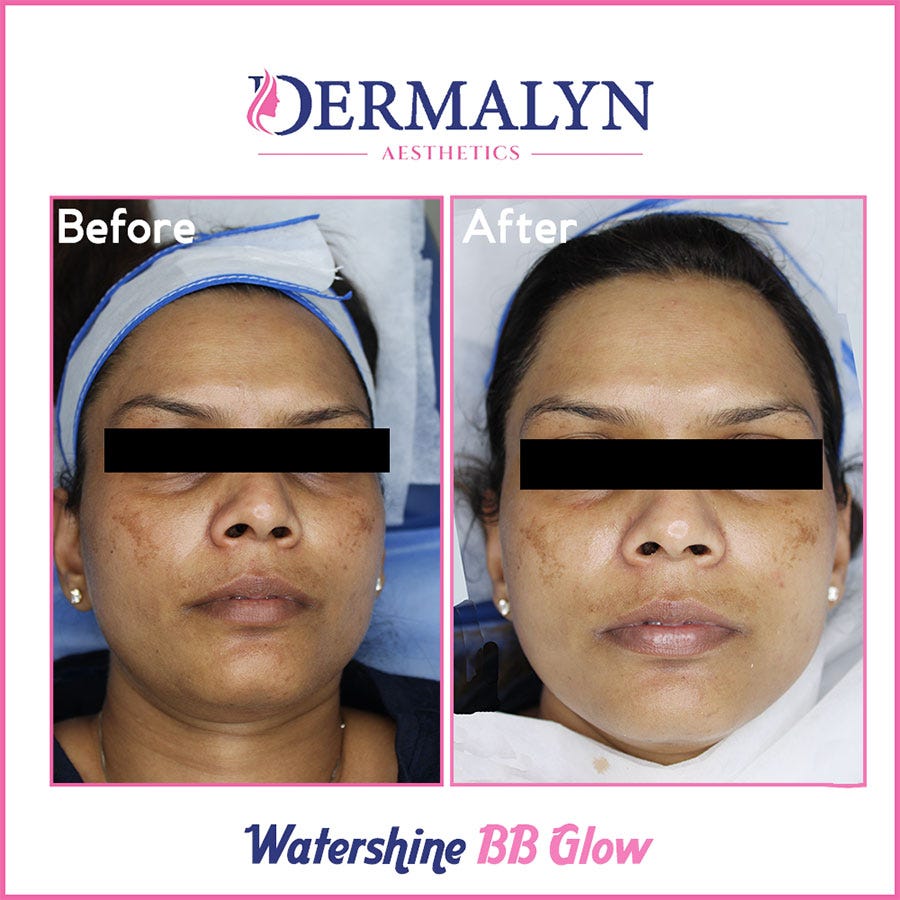 BB Glow Treatment in Delhi - DermalynAesthetics - Medium