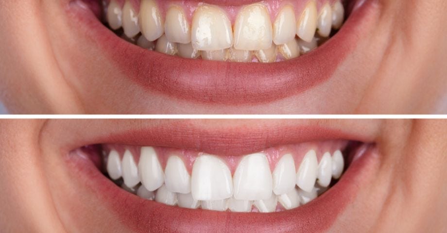 Step-by-Step Teeth Whitening at Home: What You Need to Know | by White ...