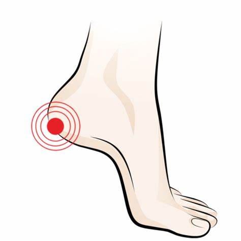 What suitable exercises can heel spurs patients choose? 1. Swimming ...