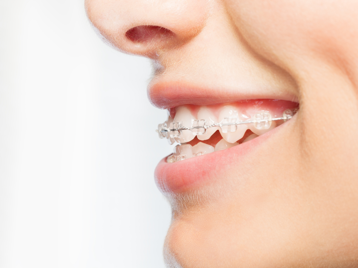 Orthodontist in Bronx. Do you want to show off a killer smile… | by Northeasternbraces | Medium