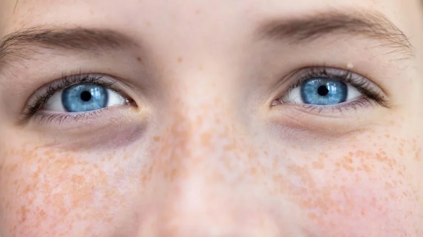 Ocular Synechiae: Causes, Symptoms, Treatment | by Eyecare.live | Jul, 2024 | Medium