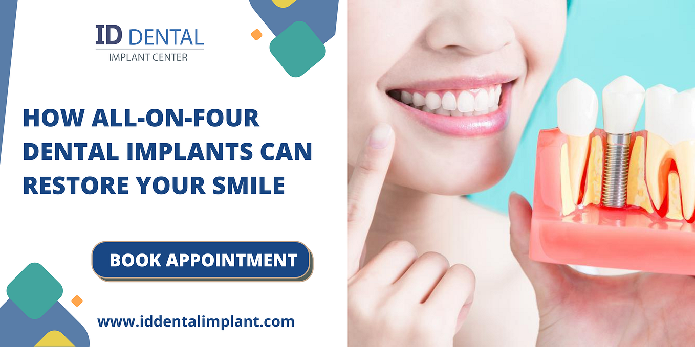 All On Four Dental Implant — A Lasting Solution for Missing Teeth | by ID Dental and Implant ...